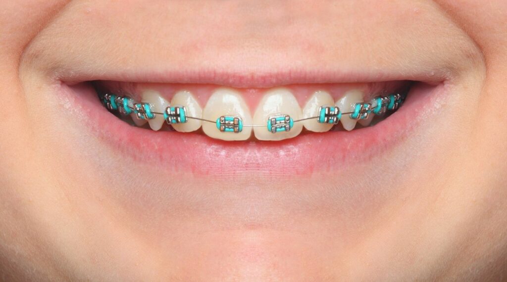 Colored Braces - Murray Orthodontics
