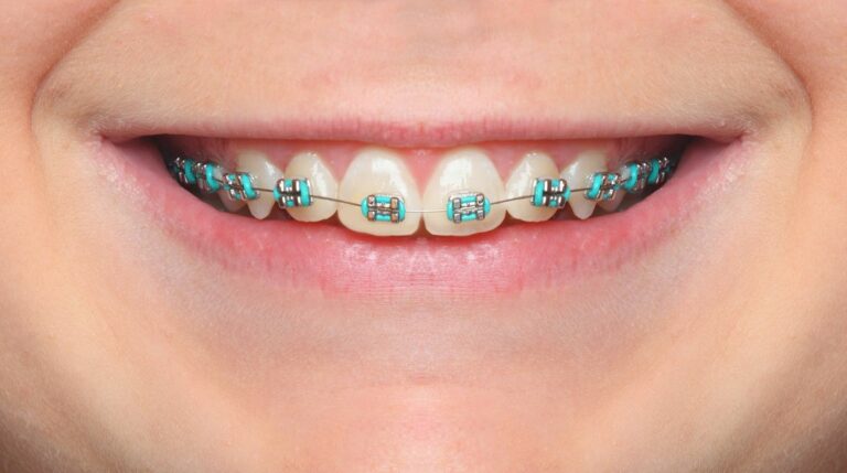 Colored Braces - Murray Orthodontics
