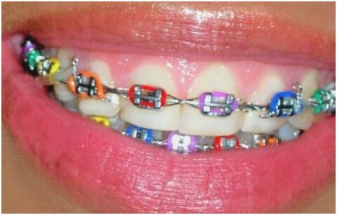 Colored Braces - Murray Orthodontics